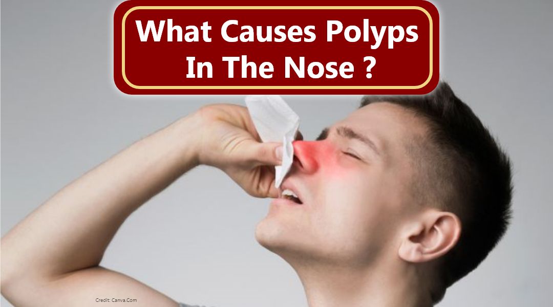 Best Treatment For Nasal Polyps Nasal Polyp Treatment Nose Polyps